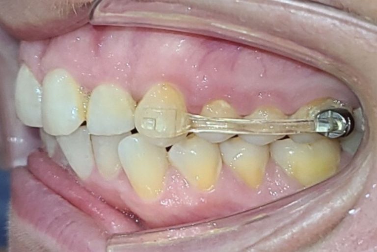 Uso de Carriere en Ortodoncia / Raga Valencia