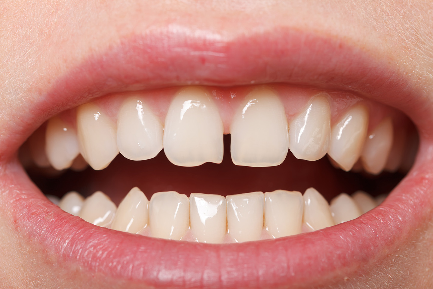 Diastema dental o dientes separados | ¿Cómo corregirlo?
