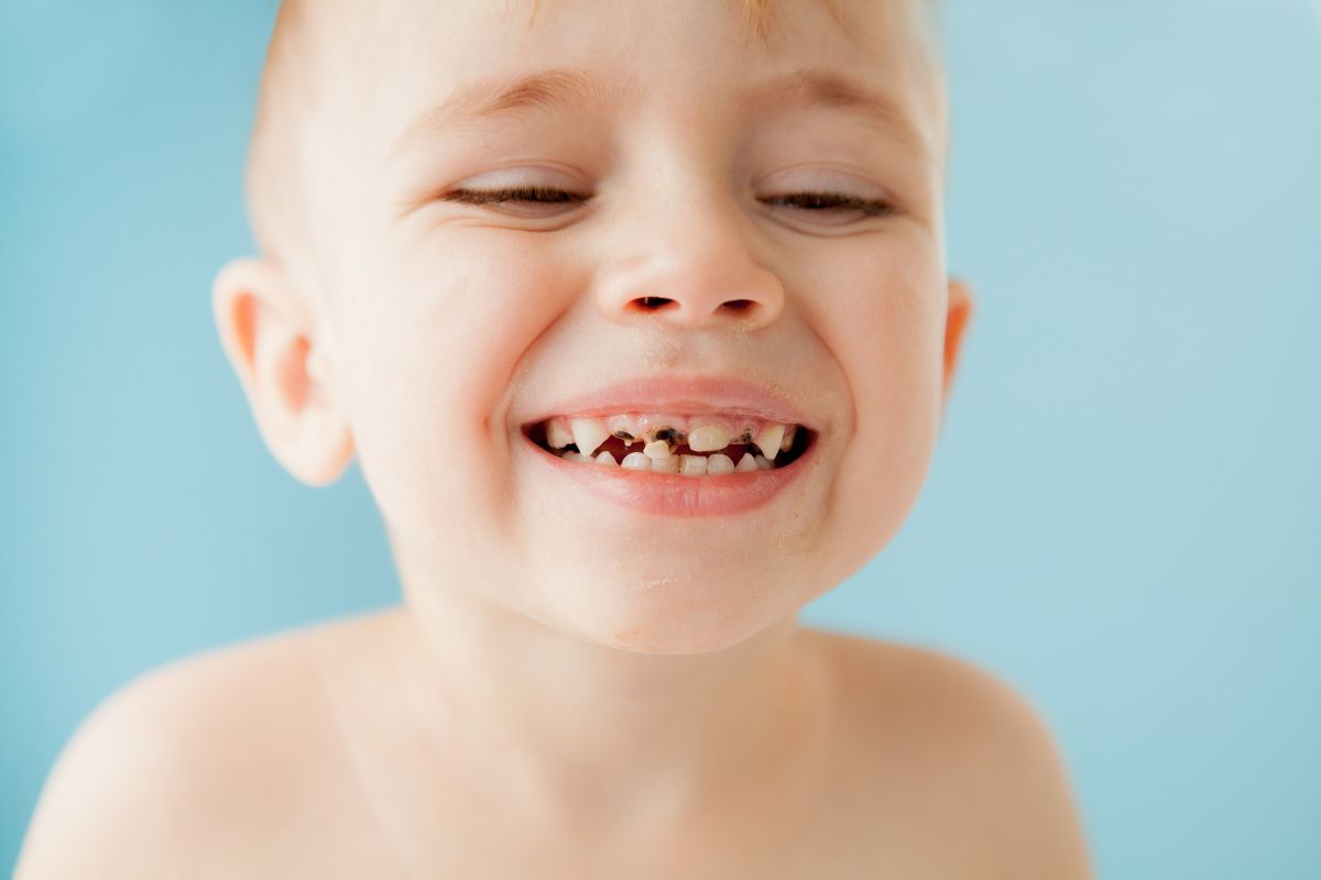 Dientes con caries en niños: causas, tratamiento y prevención